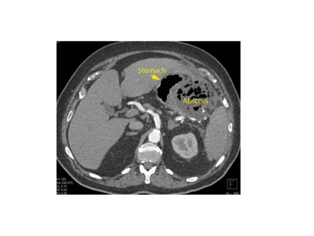 PANCREATITIS