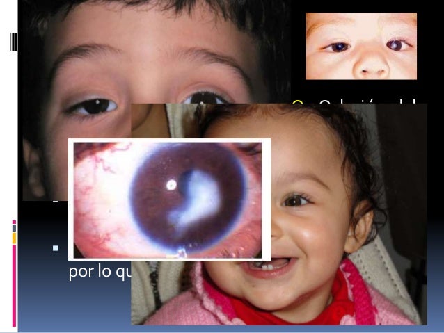 Presentación ambliopía funcional