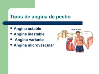 angina de pecho | PPT