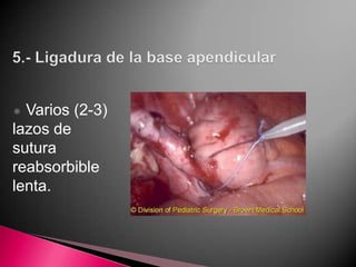 Apendicectomia Laparoscopica | PPTX