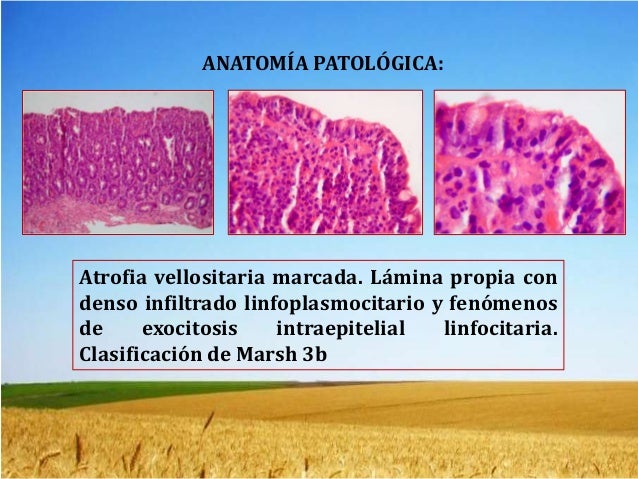 Presentación celiaquía