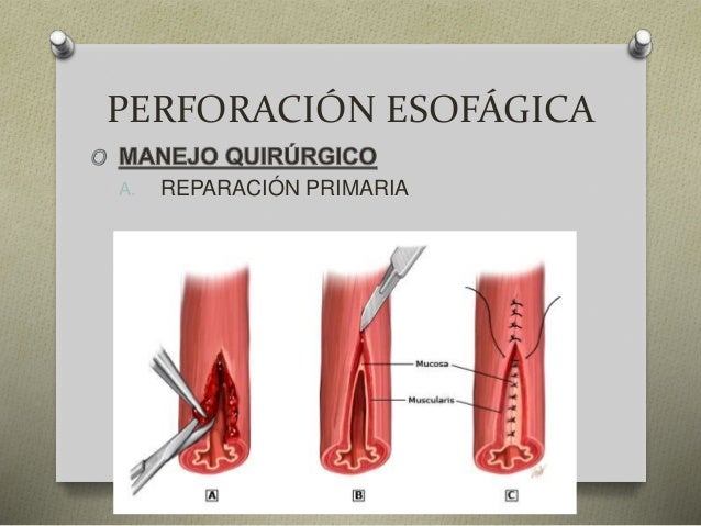 Caso clínico Perforación esofágica espontánea