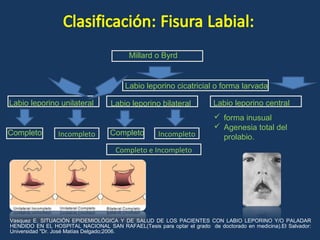 Labio Fisurado y Paladar Hendido | PPT