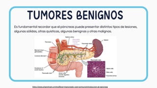 Tumores benignos y malignos de páncreas. | PDF