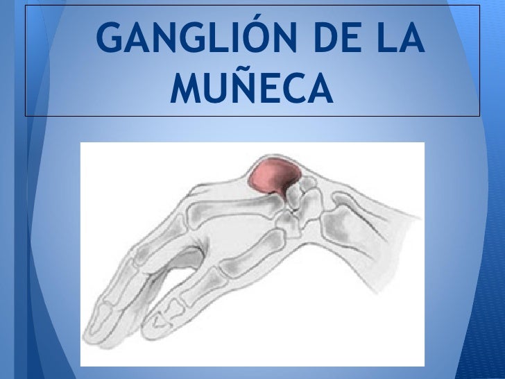 Presentación ganglion
