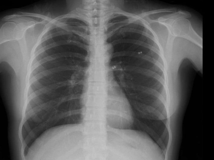 Presentación Imagen Torax Normal