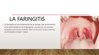 Presentación Faringitis | PPTX