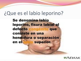 Presentación labio leporino | PPTX