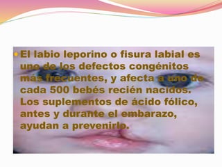 Presentación labio leporino | PPTX