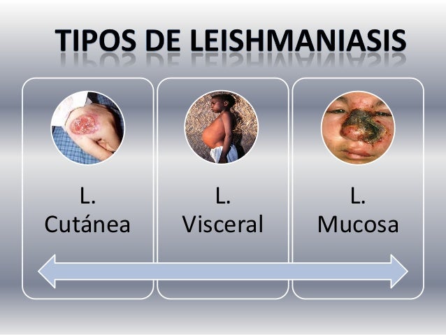 Presentación leishmaniasis