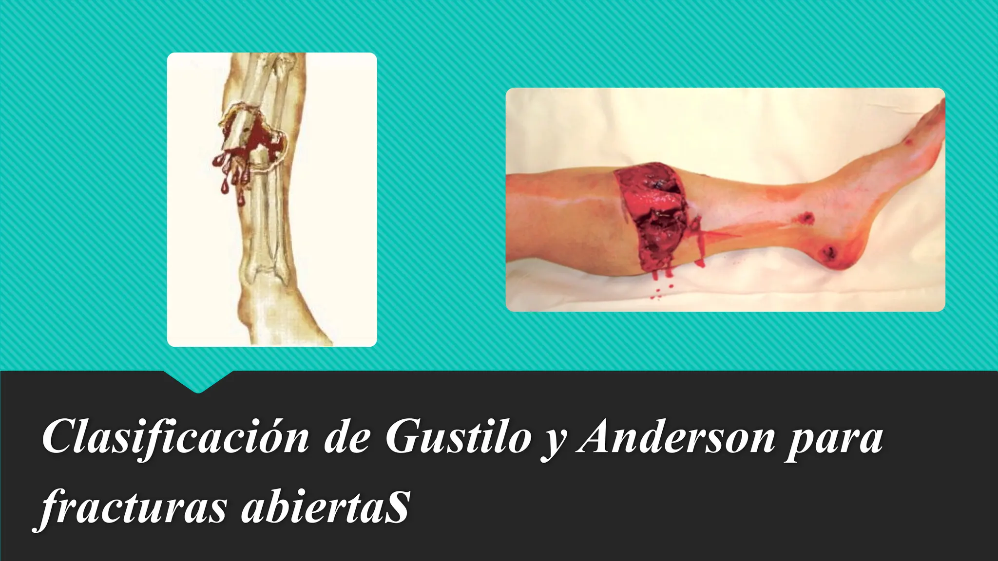 Clasificación de Gustilo y Anderson para fracturas abiertas.pptx