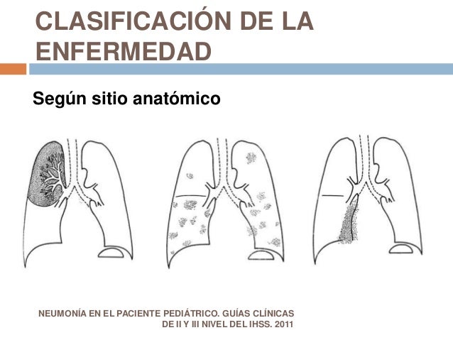 Presentación neumonia