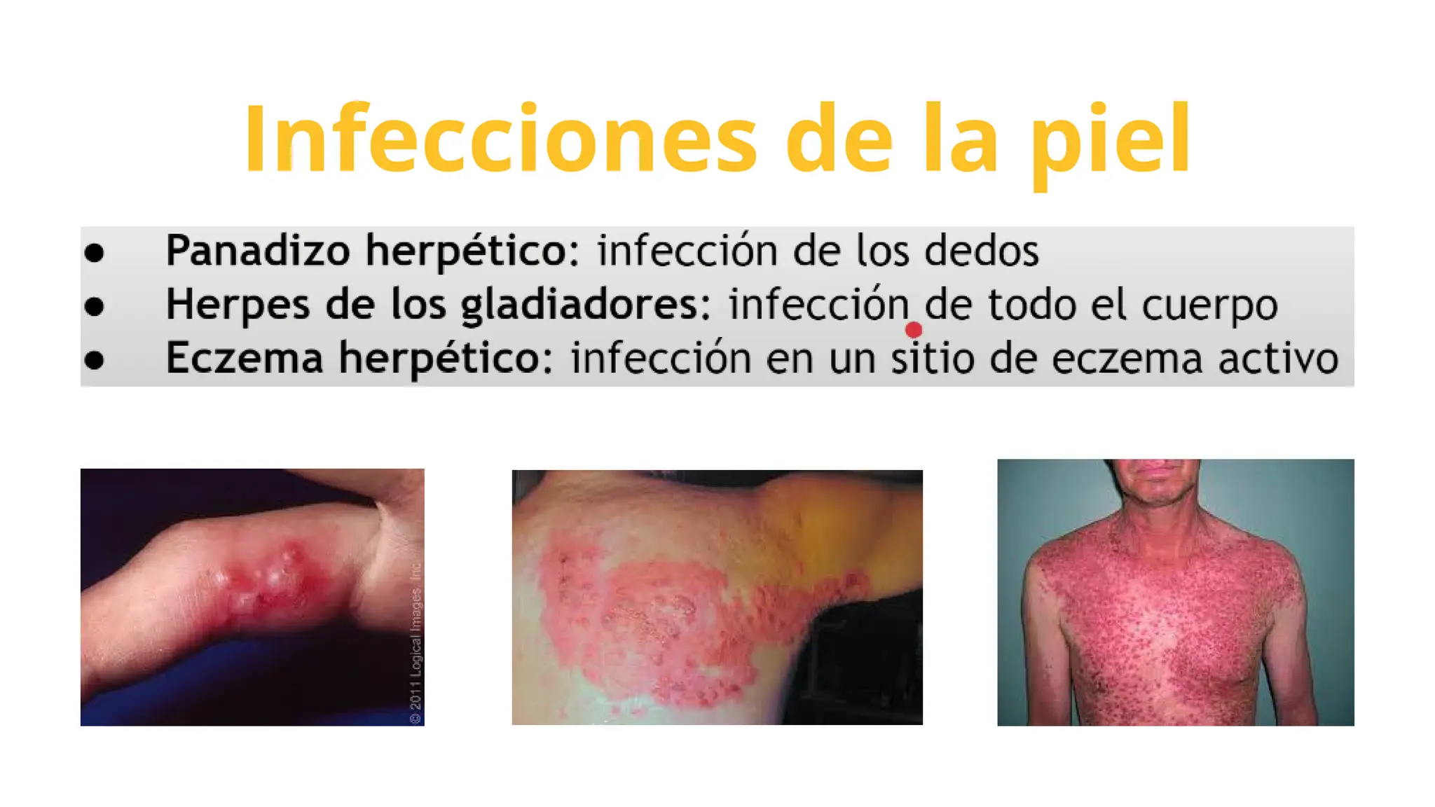 Virus del Herpes, tipos, clasificación, cuadro clínico, etc. | PDF