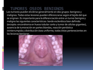 Radiología: Lesiones benignas (En torus palatino) | PPTX