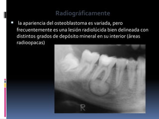 Radiología: Lesiones benignas (En torus palatino) | PPTX