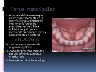 Radiología: Lesiones benignas (En torus palatino) | PPTX