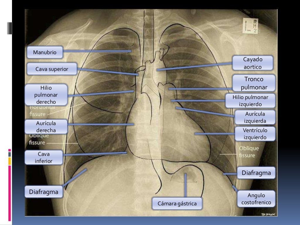 Radiografia De Torax Anatomia Radiologica Y Interpretacion De Una ... Radiografia De Torax Anatomia Radiologica Y Interpretacion De Una ...