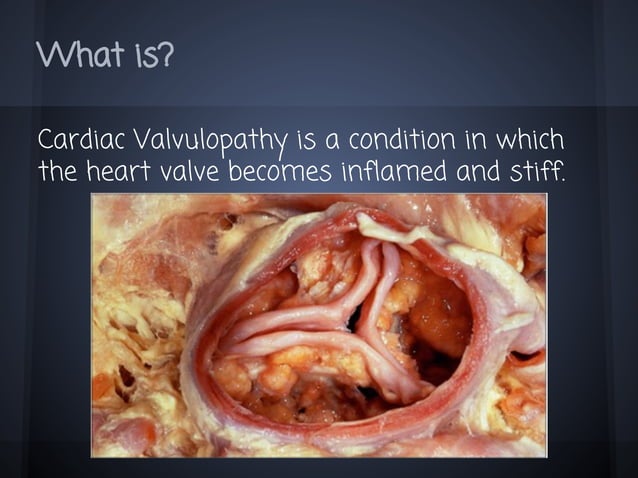 Cardiac valvulopathy - Maria Bouzaid | PDF | Heart and Cardiovascular ...