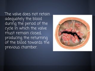 Cardiac valvulopathy - Maria Bouzaid | PDF | Heart and Cardiovascular ...