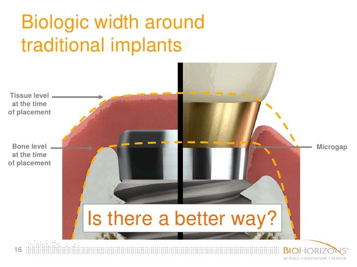 Presentaciòn sistema de implantes biohorizons