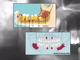 QUERATOQUISTES - Dr Fiori | PPT