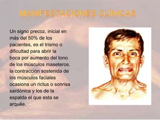 Presentación tetanos | PPTX