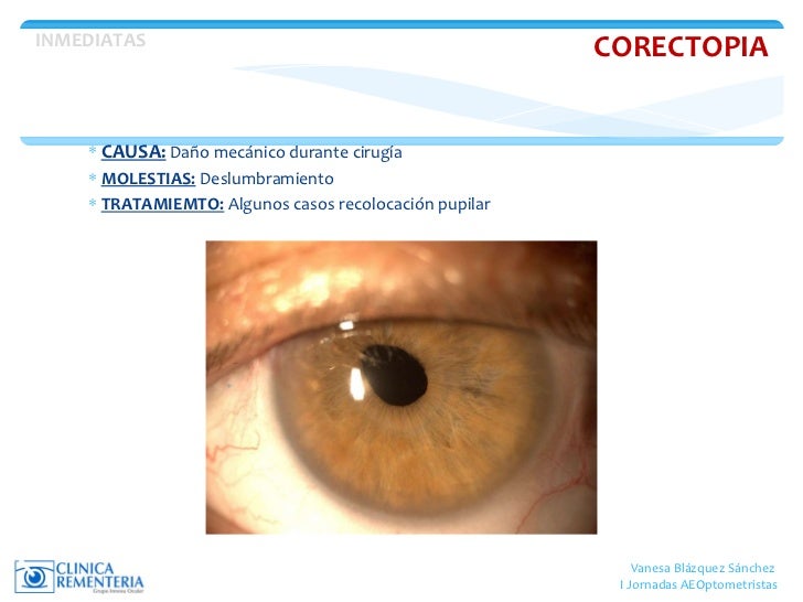 Cirugía de Cataratas y Molestias Asociadas