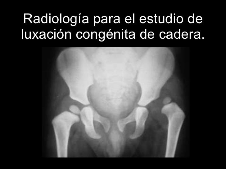 placa simple para el diagnostico de luxacino congenita de cadera