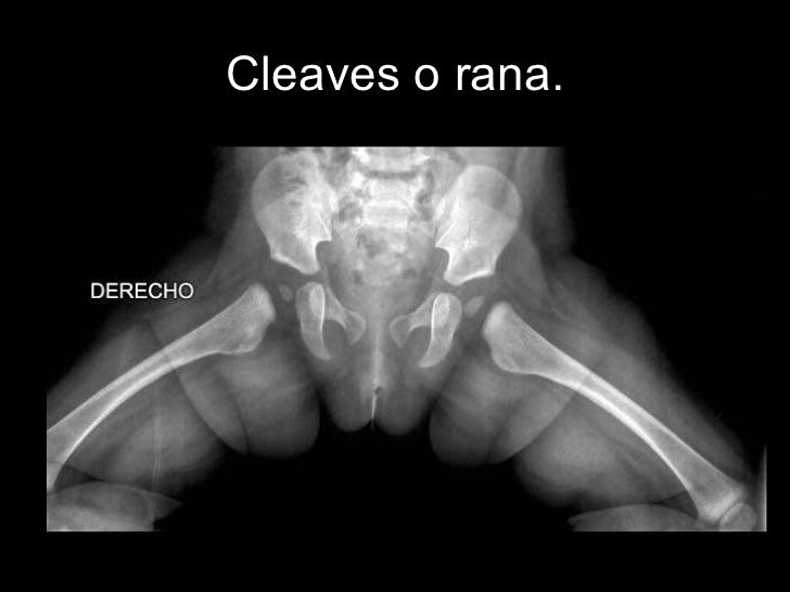 placa simple para el diagnostico de luxacino congenita de cadera