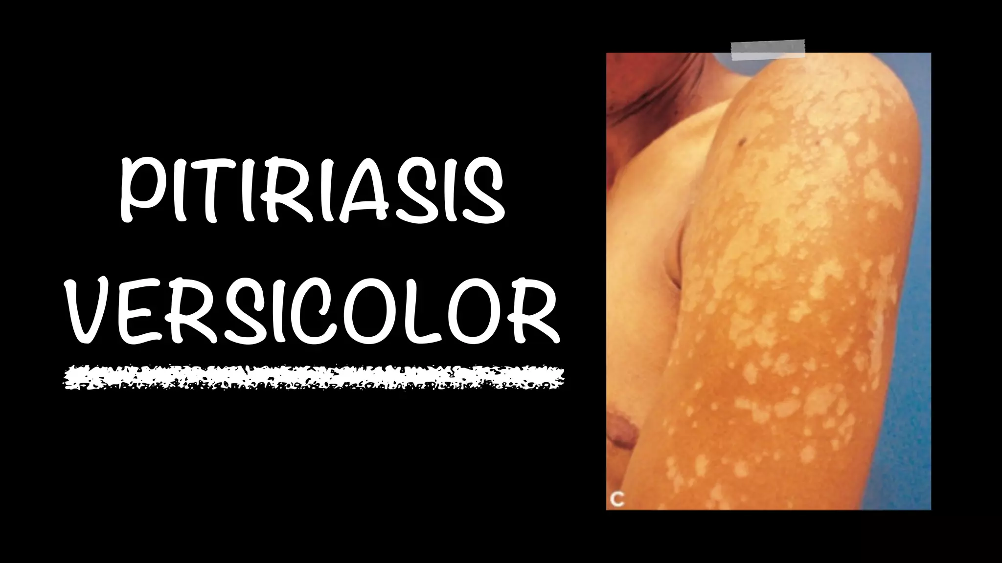 PITIRIASIS.pdf