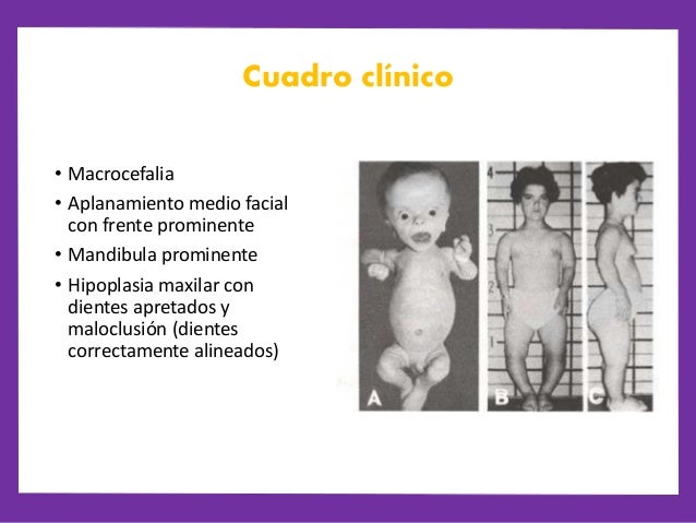 Presentacion acondroplasia