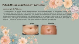 PRESENTACION VACUMTERAPIA y importancia de la misma | PPTX