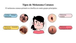 Presentacion Cancer de Melanoma..pptx