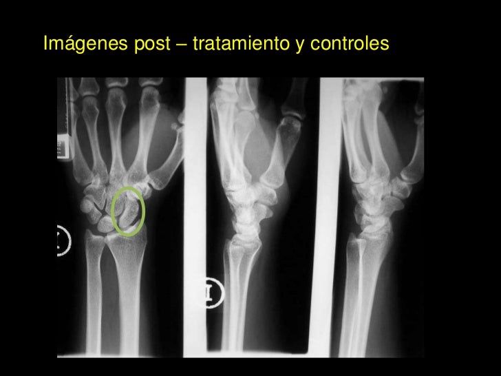 fractura de escafoides