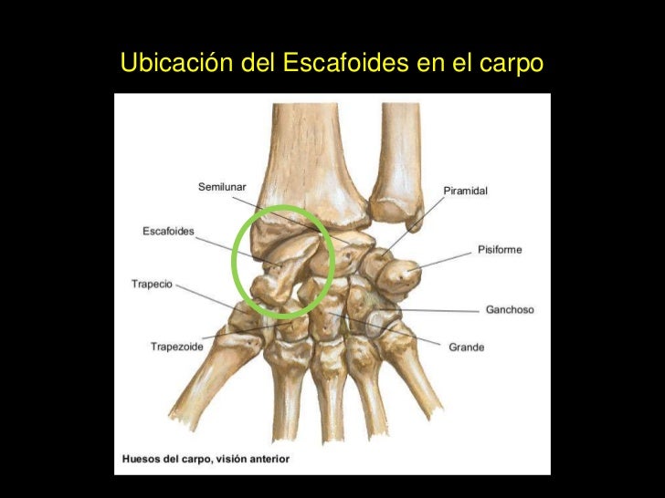 fractura de escafoides