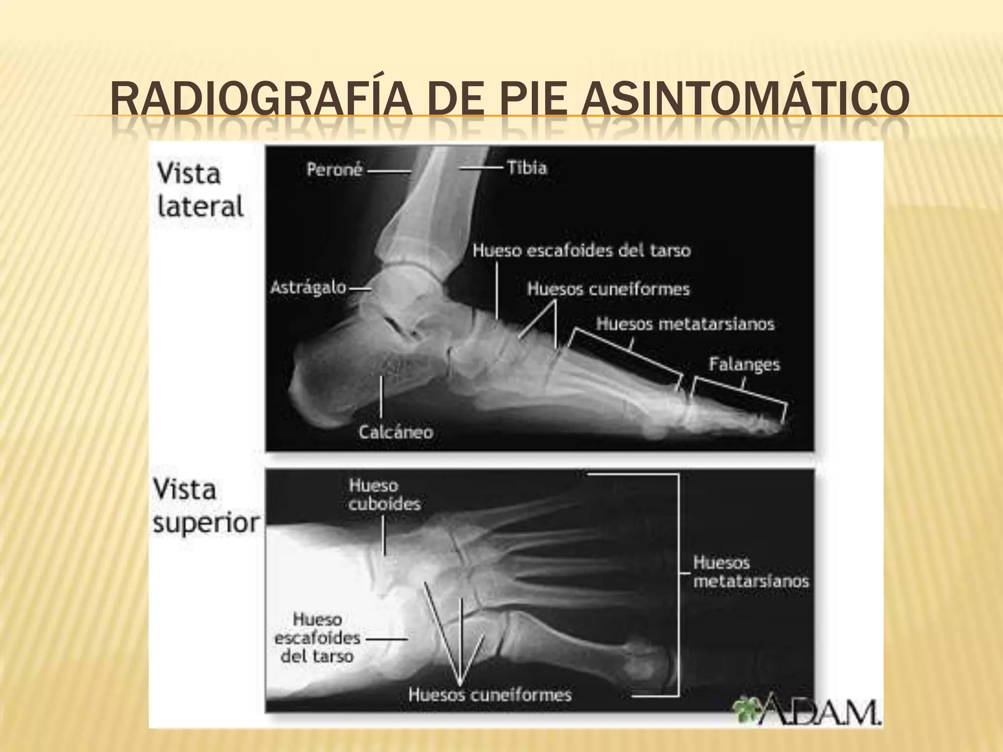 Caso clinico - Musculoesqueletico - Pie Plano | PPTX | Foot Health ...