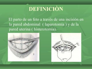 Presentacion cesarea | PPT