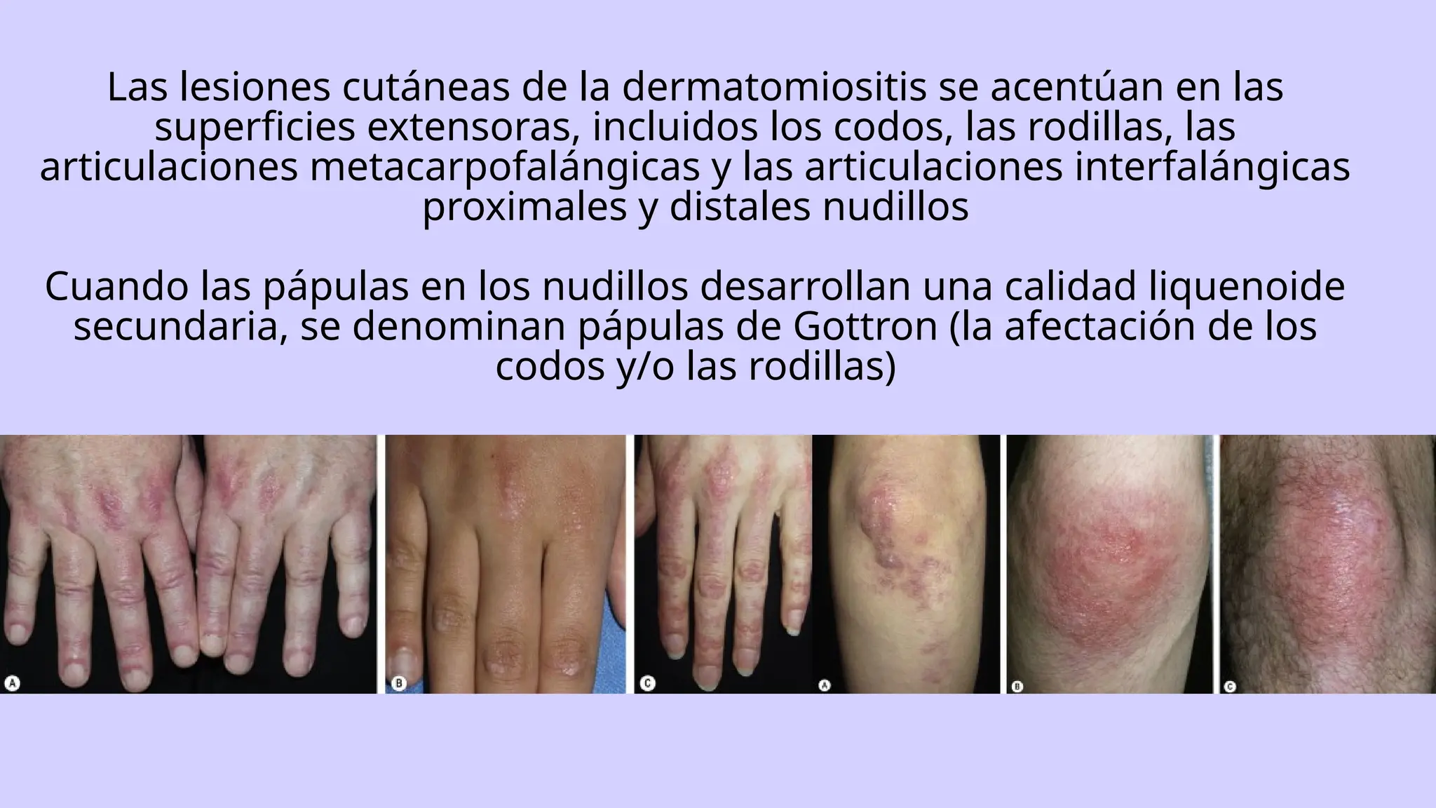 Dermatomiositis ( enfermedad reumatologica) | PPTX