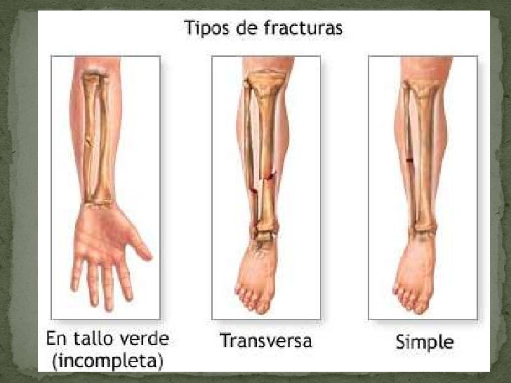 Presentacion de fracturas,,,,,