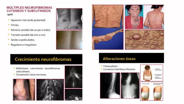 Neurofibromatosis tipo 1 diapositivas :3 | PDF