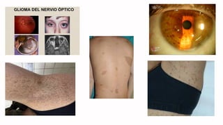 Neurofibromatosis tipo 1 diapositivas :3 | PDF