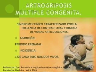 Presentacion de orientacion sobre artrogriposis | PPS