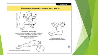 Presentación de la enfermedad de la Rubeola Y Síndrome de Rubeola ...