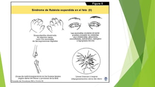 Presentación de la enfermedad de la Rubeola Y Síndrome de Rubeola ...