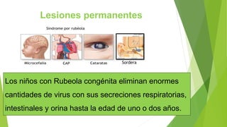 Presentación de la enfermedad de la Rubeola Y Síndrome de Rubeola ...