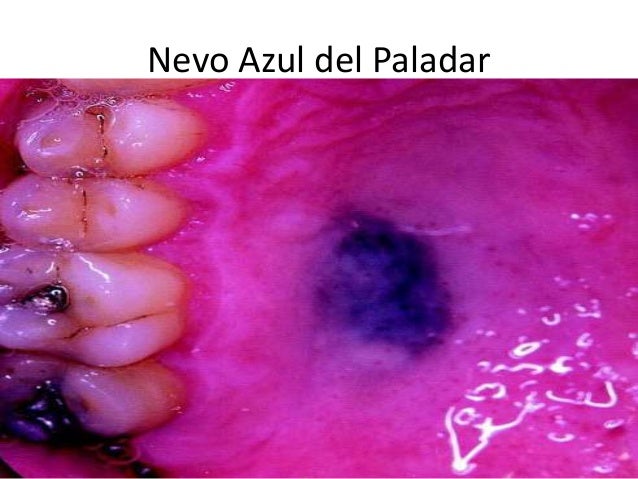 Presentación de trastornos epiteliales