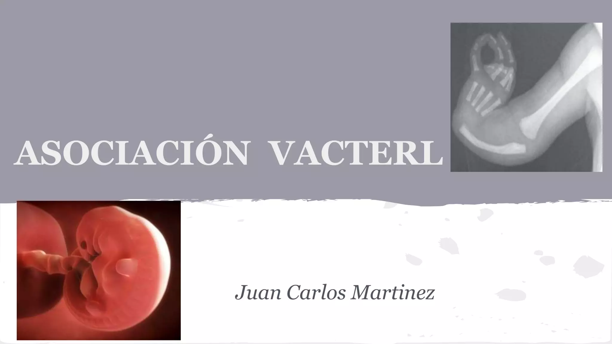Presentacion de vacterl | PPTX