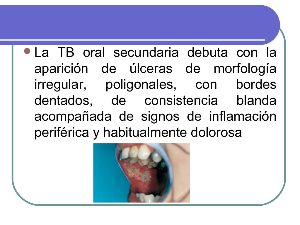 Tuberculosis pulmonar, ¿Tuberculosis oral?