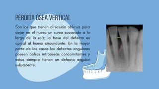 Pérdida ósea, patrones de destrucción perio | PDF