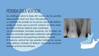Pérdida ósea, patrones de destrucción perio | PDF